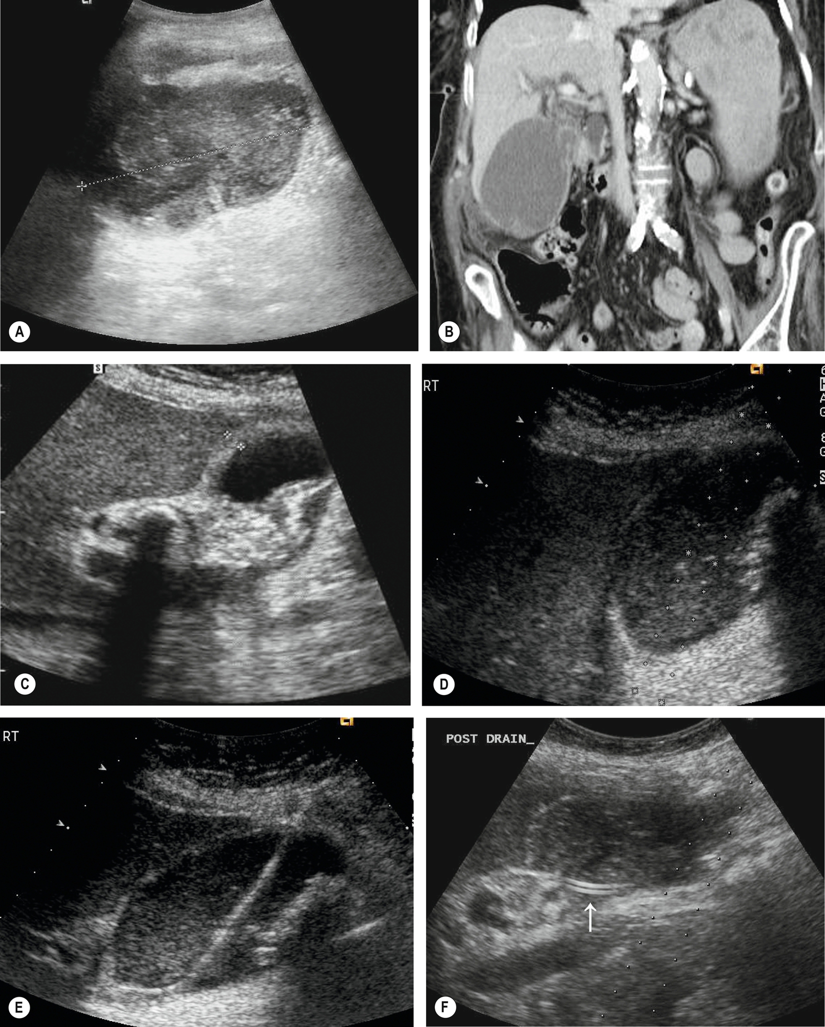 3: Ultrasound of the Gallbladder and Biliary Tree