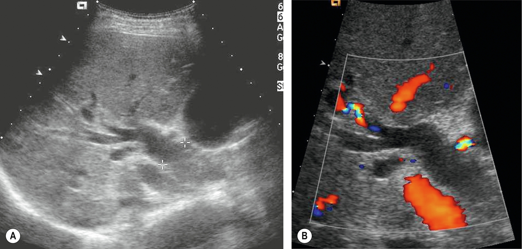 3: Ultrasound of the Gallbladder and Biliary Tree