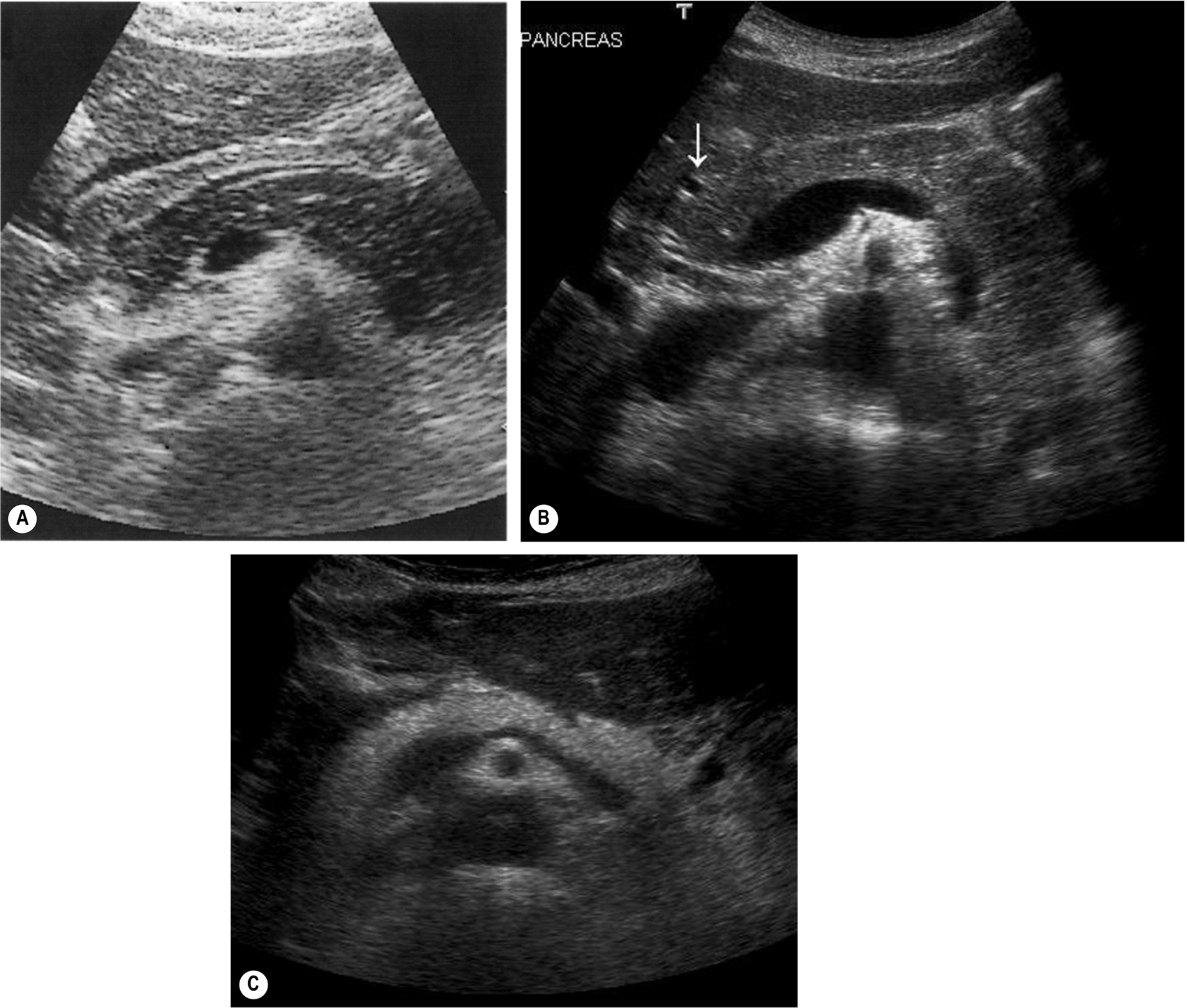 4: Ultrasound of the Pancreas
