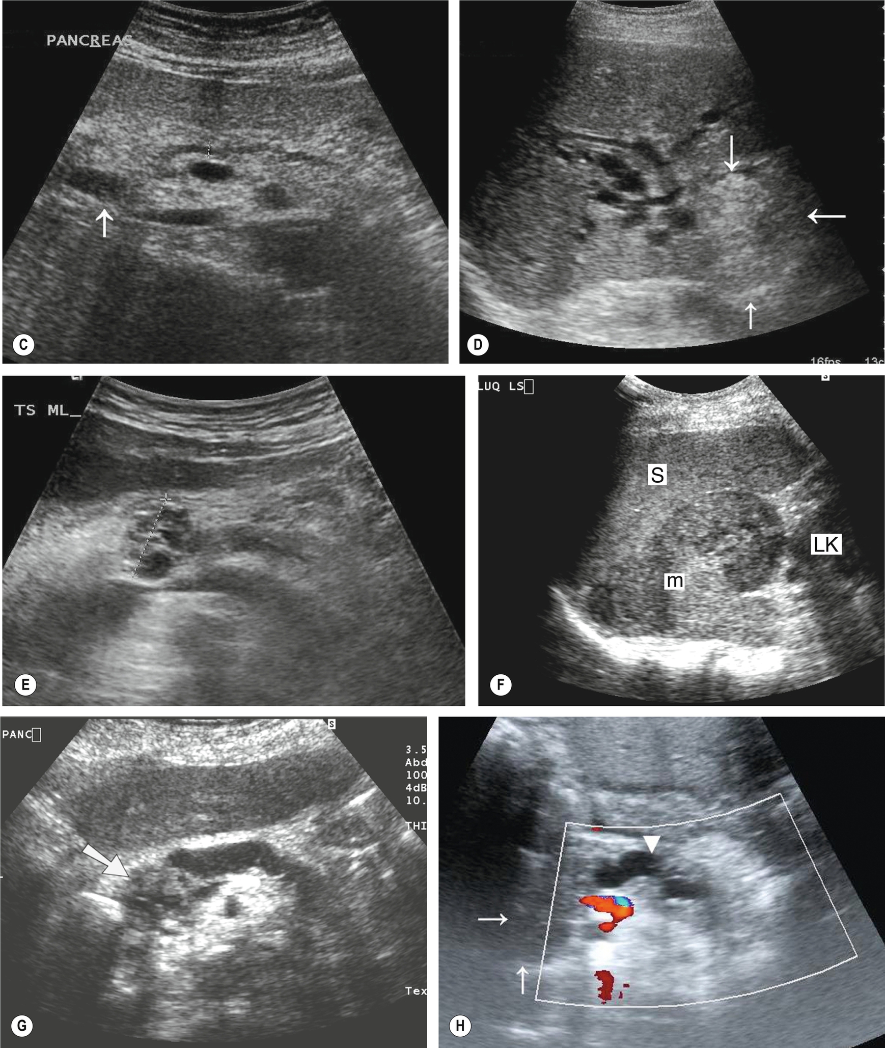 4: Ultrasound of the Pancreas