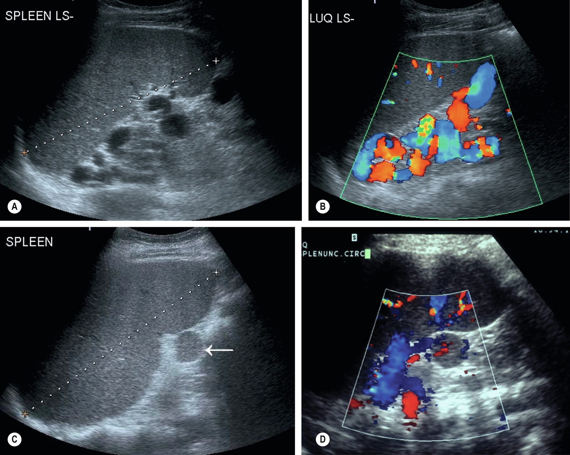 5: Ultrasound of the Spleen and Lymphatic System