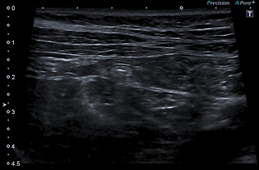 8: Ultrasound of the Retroperitoneum and Gastrointestinal Tract