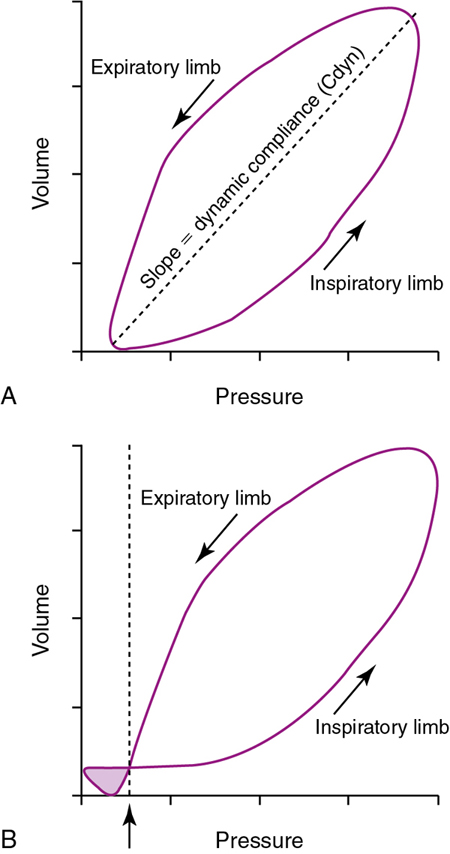 Ventilator waveforms