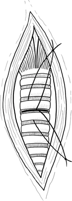 Endotracheal intubation and tracheostomy