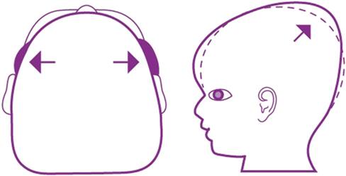 Chapter 11: Congenital Muscular Torticollis and Cranial Deformation