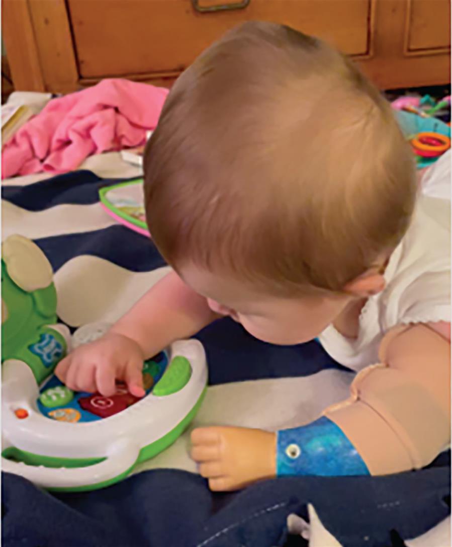 Chapter 15: Limb Deficiencies and Amputations