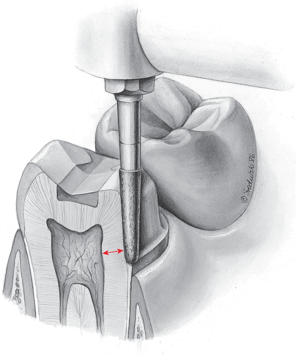 7: Principles of Tooth Preparation