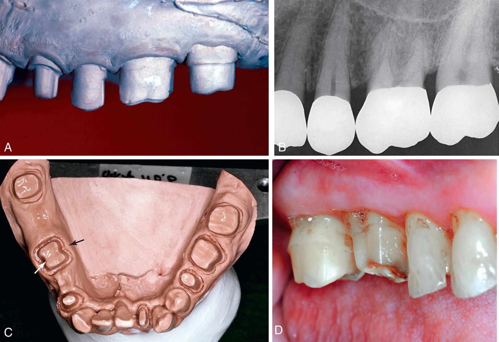 7: Principles of Tooth Preparation
