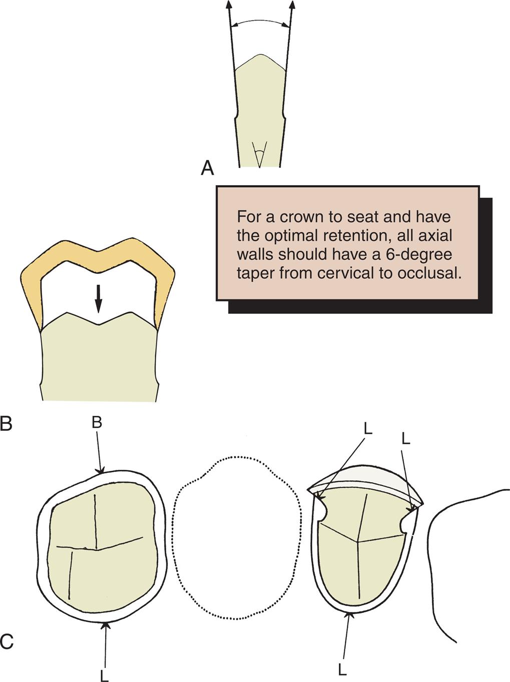 7: Principles of Tooth Preparation
