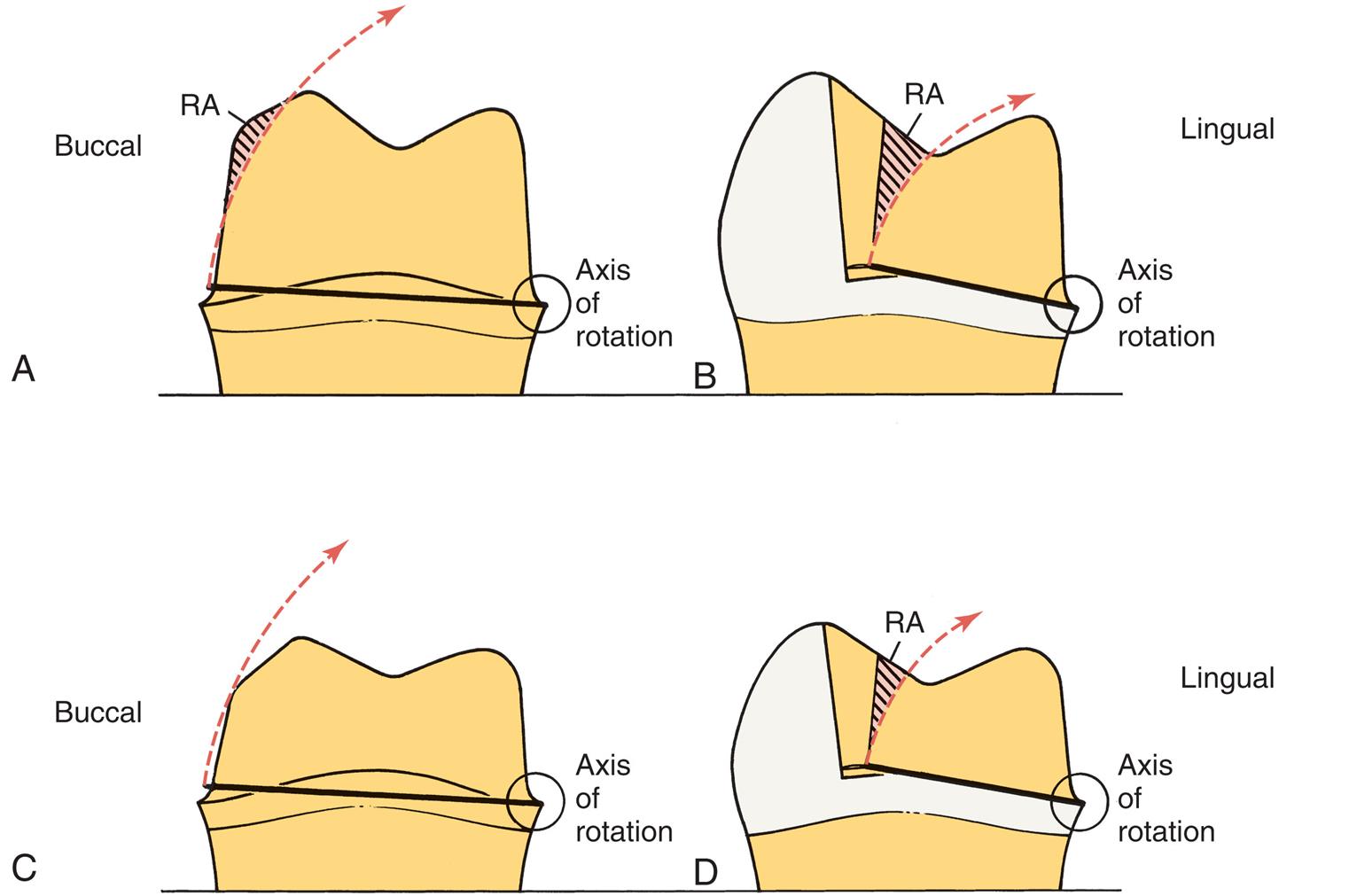 7: Principles of Tooth Preparation