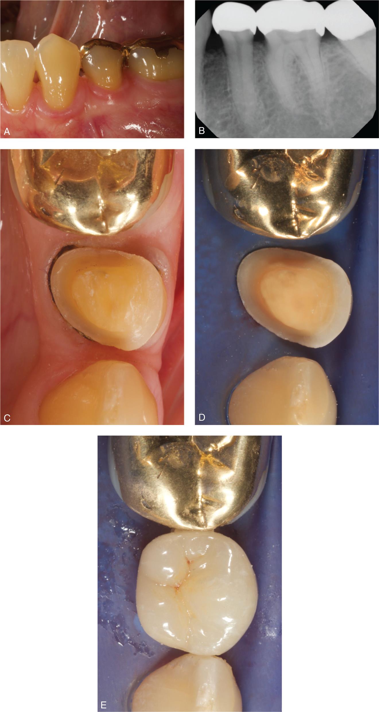 8: Tooth Preparation for Ceramic Restorations