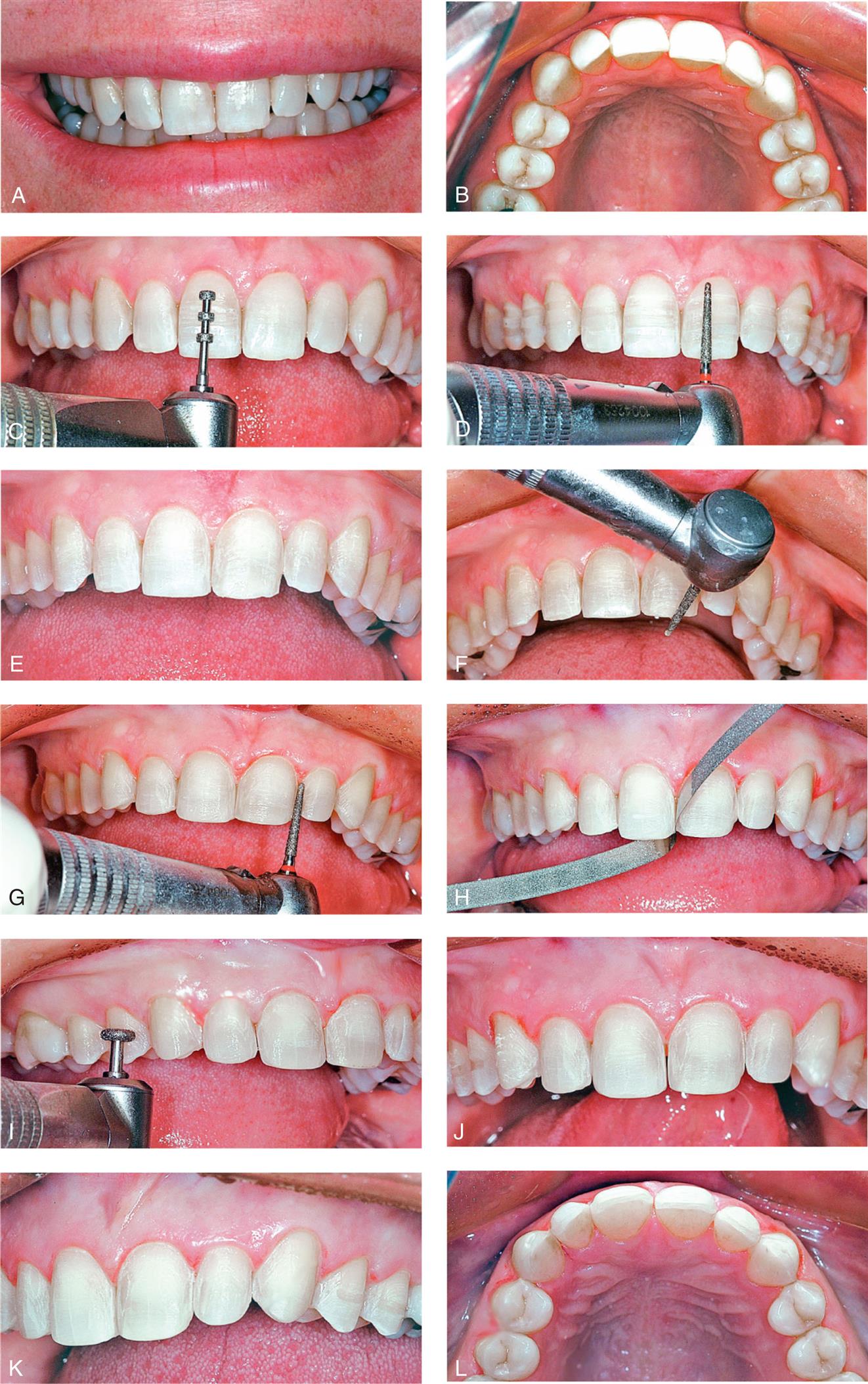 8: Tooth Preparation for Ceramic Restorations