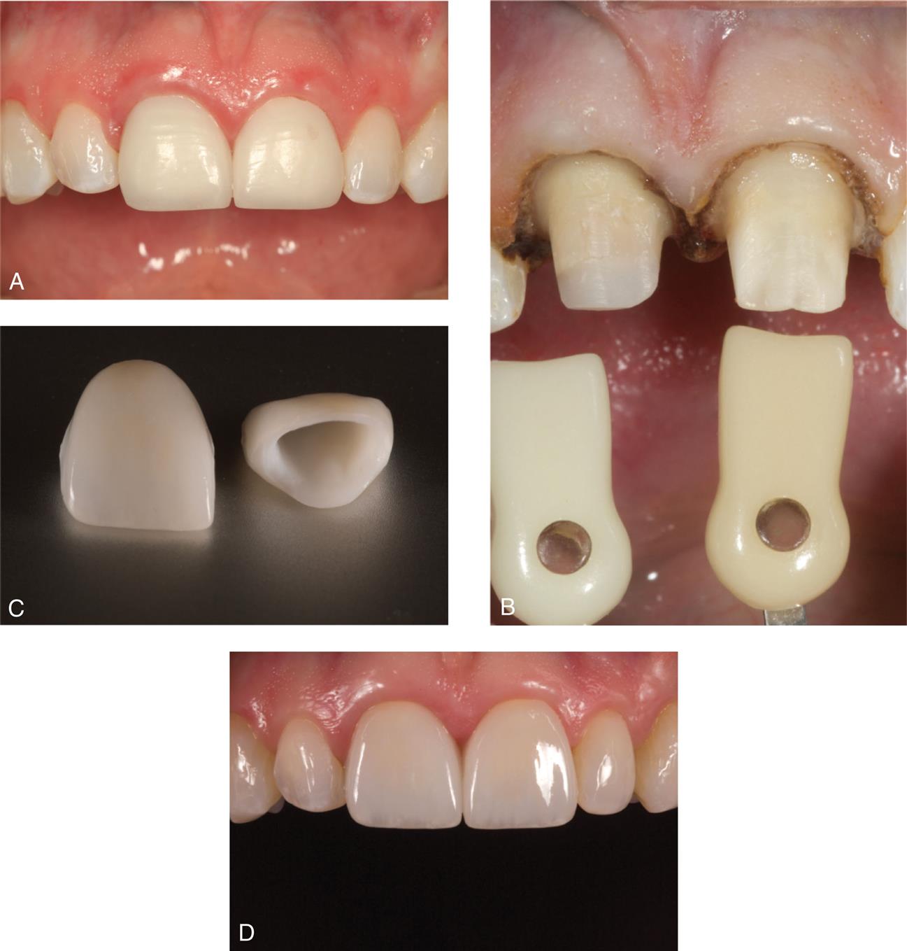 8: Tooth Preparation for Ceramic Restorations