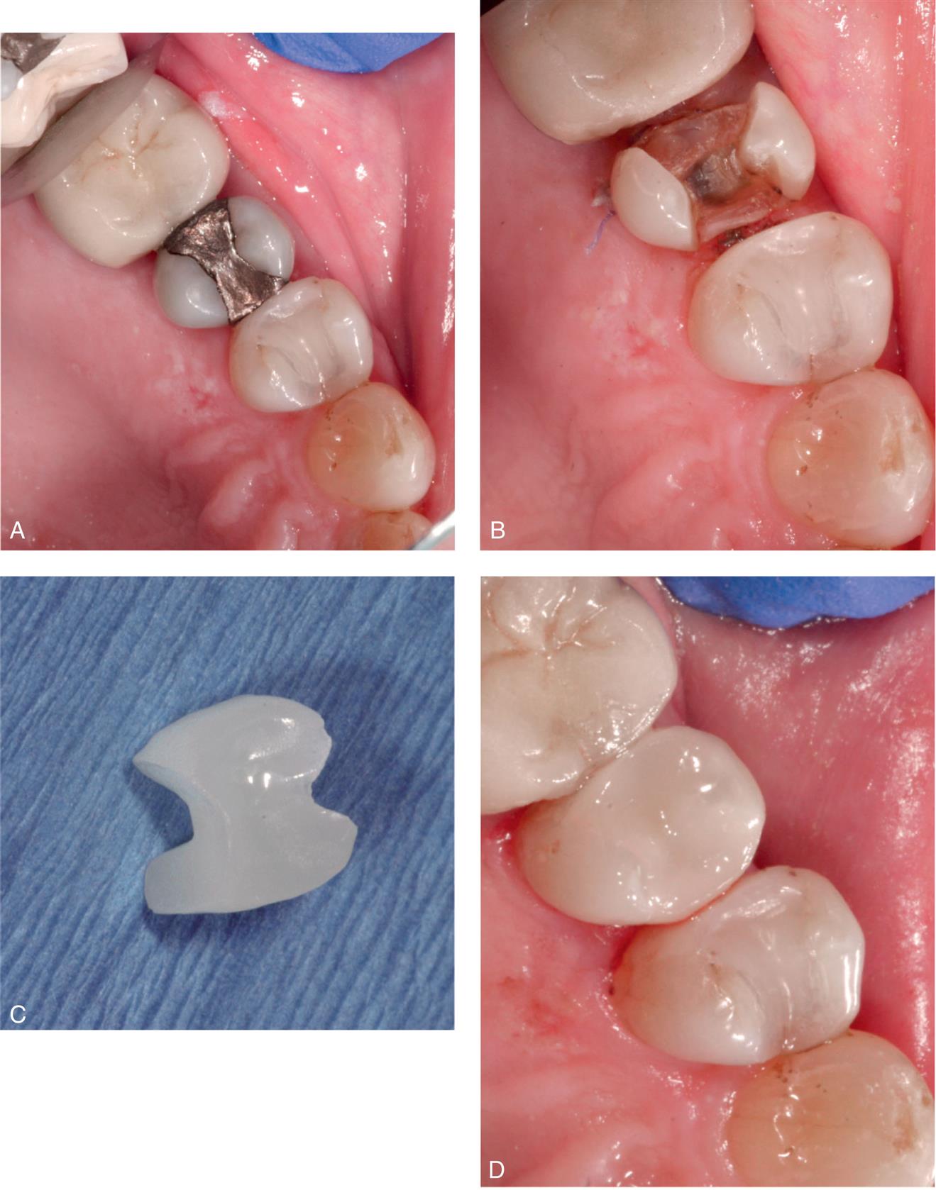 8: Tooth Preparation for Ceramic Restorations