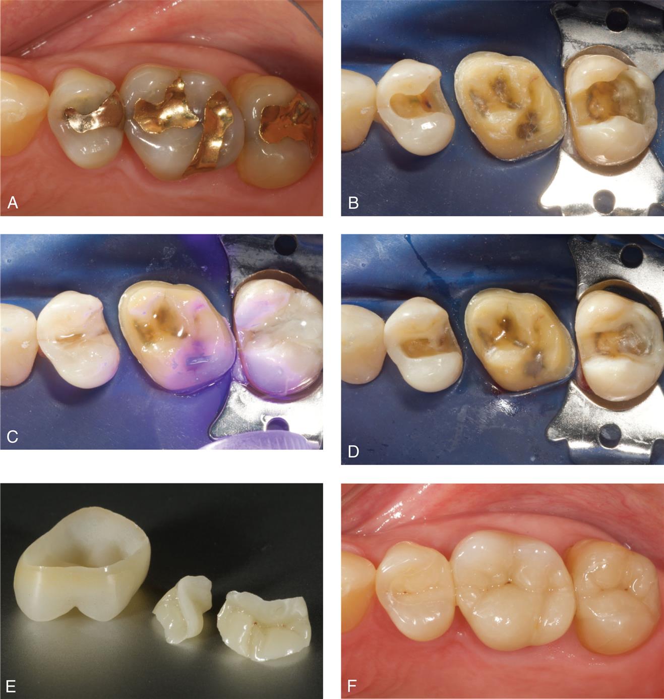 8: Tooth Preparation for Ceramic Restorations