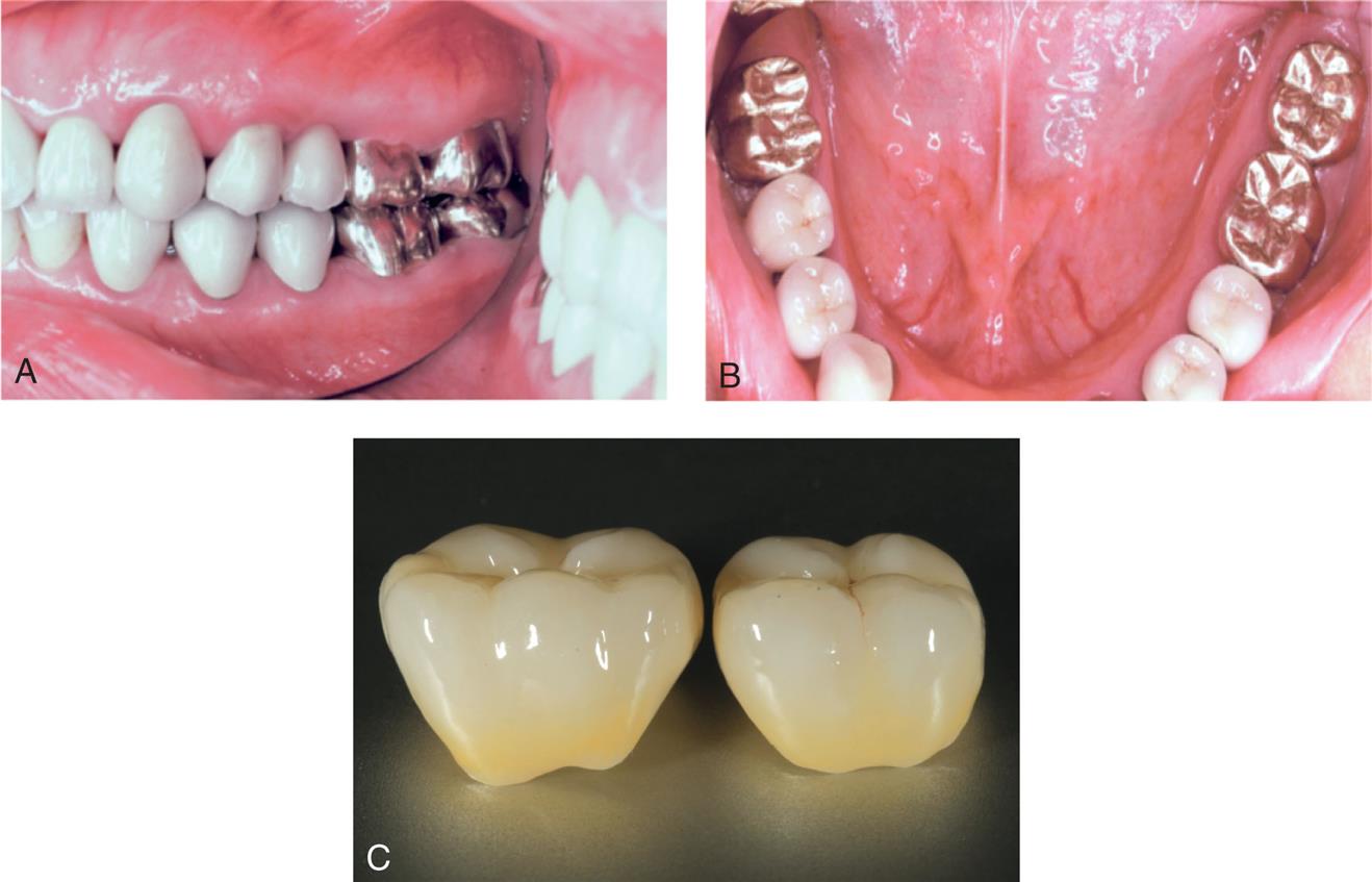 9: The Complete Crown Preparation