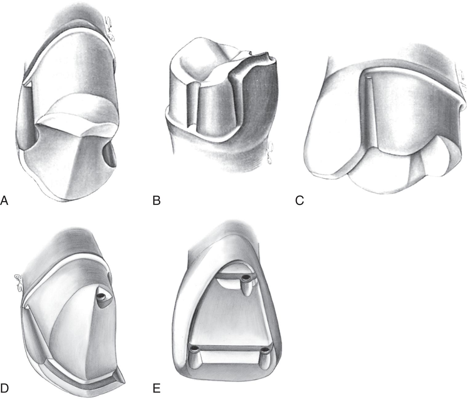 11: The Cast Partial Veneer Crown, Inlay, and Onlay Preparations