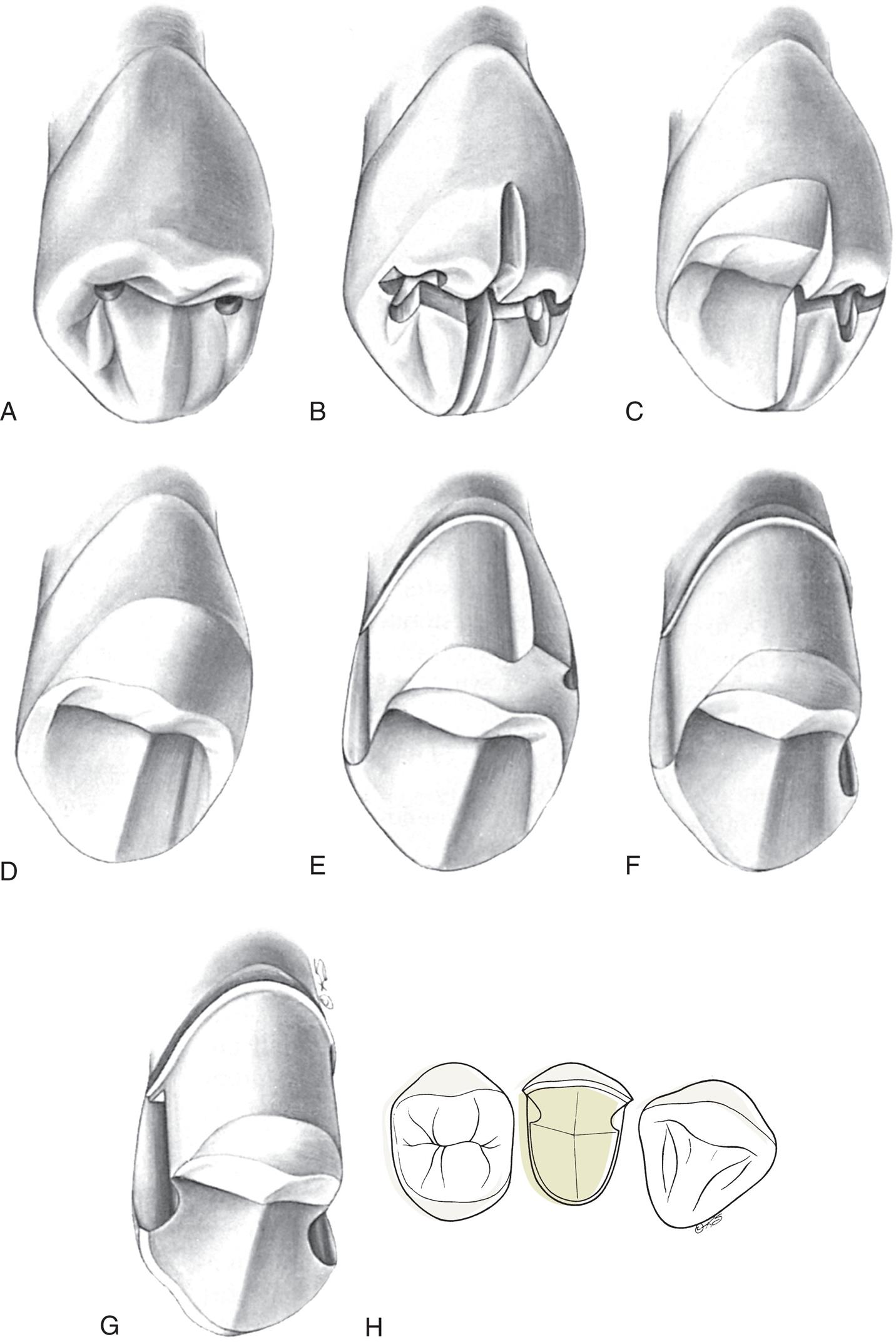 11: The Cast Partial Veneer Crown, Inlay, and Onlay Preparations
