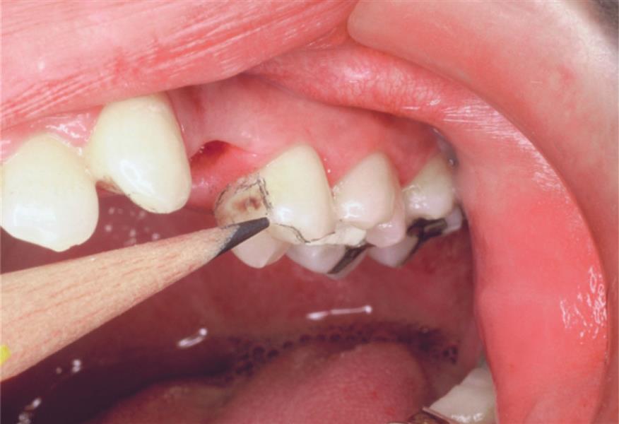 11: The Cast Partial Veneer Crown, Inlay, and Onlay Preparations