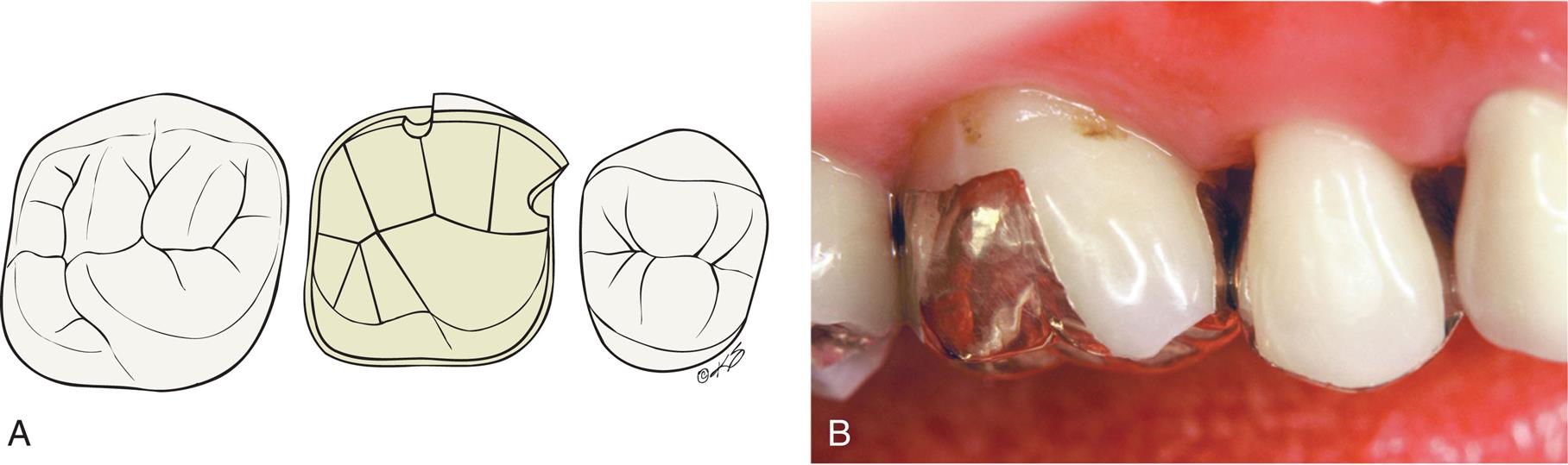 11: The Cast Partial Veneer Crown, Inlay, and Onlay Preparations
