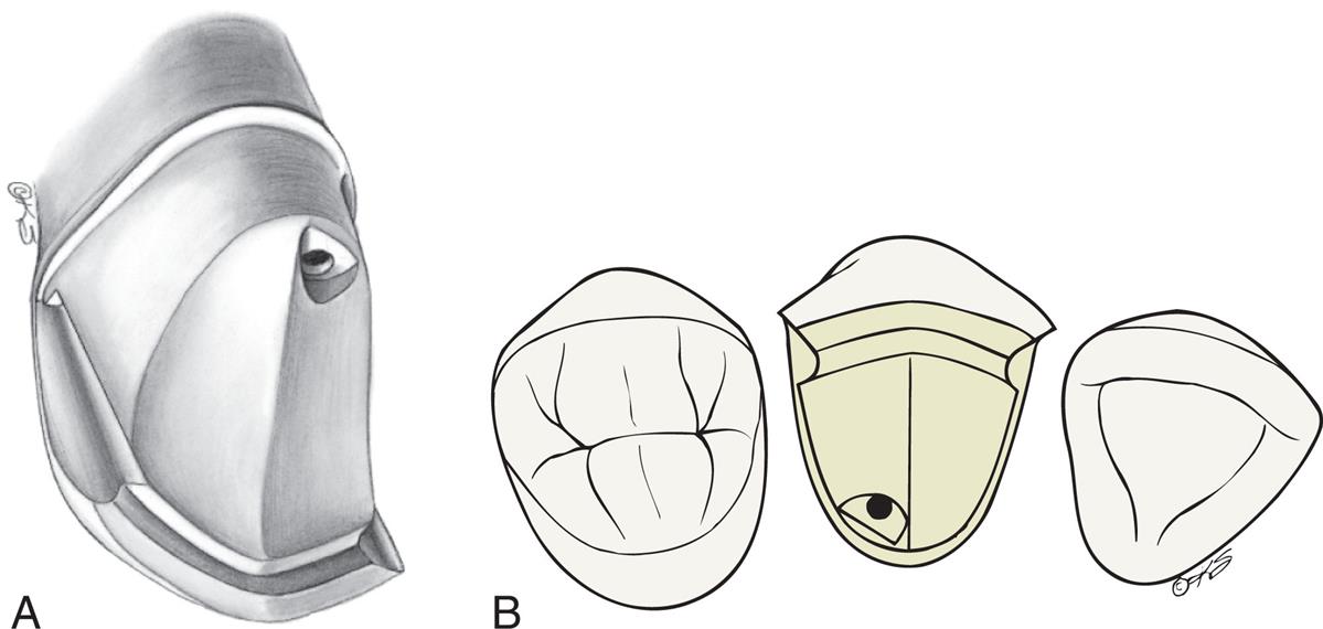 11: The Cast Partial Veneer Crown, Inlay, and Onlay Preparations