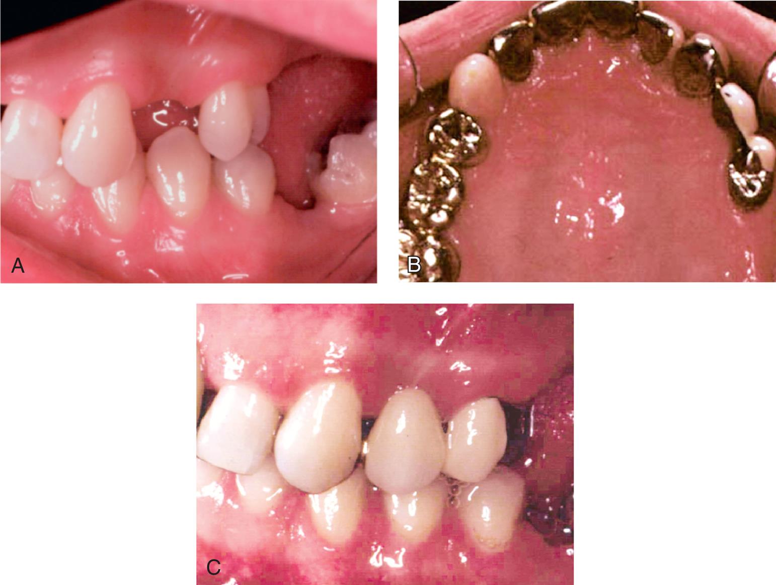 11: The Cast Partial Veneer Crown, Inlay, and Onlay Preparations