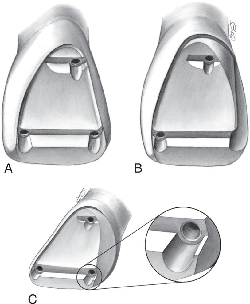 11: The Cast Partial Veneer Crown, Inlay, and Onlay Preparations
