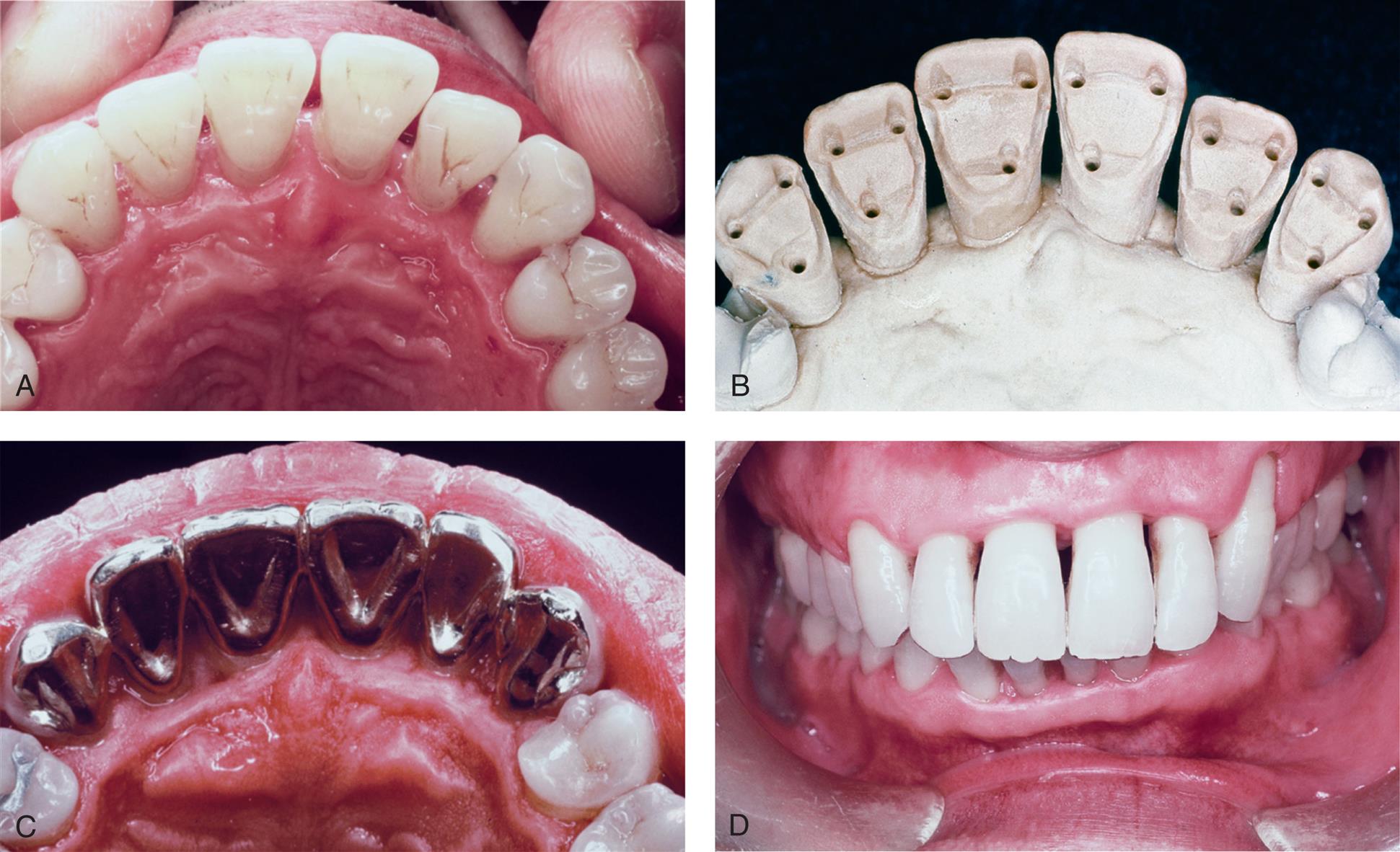 11: The Cast Partial Veneer Crown, Inlay, and Onlay Preparations