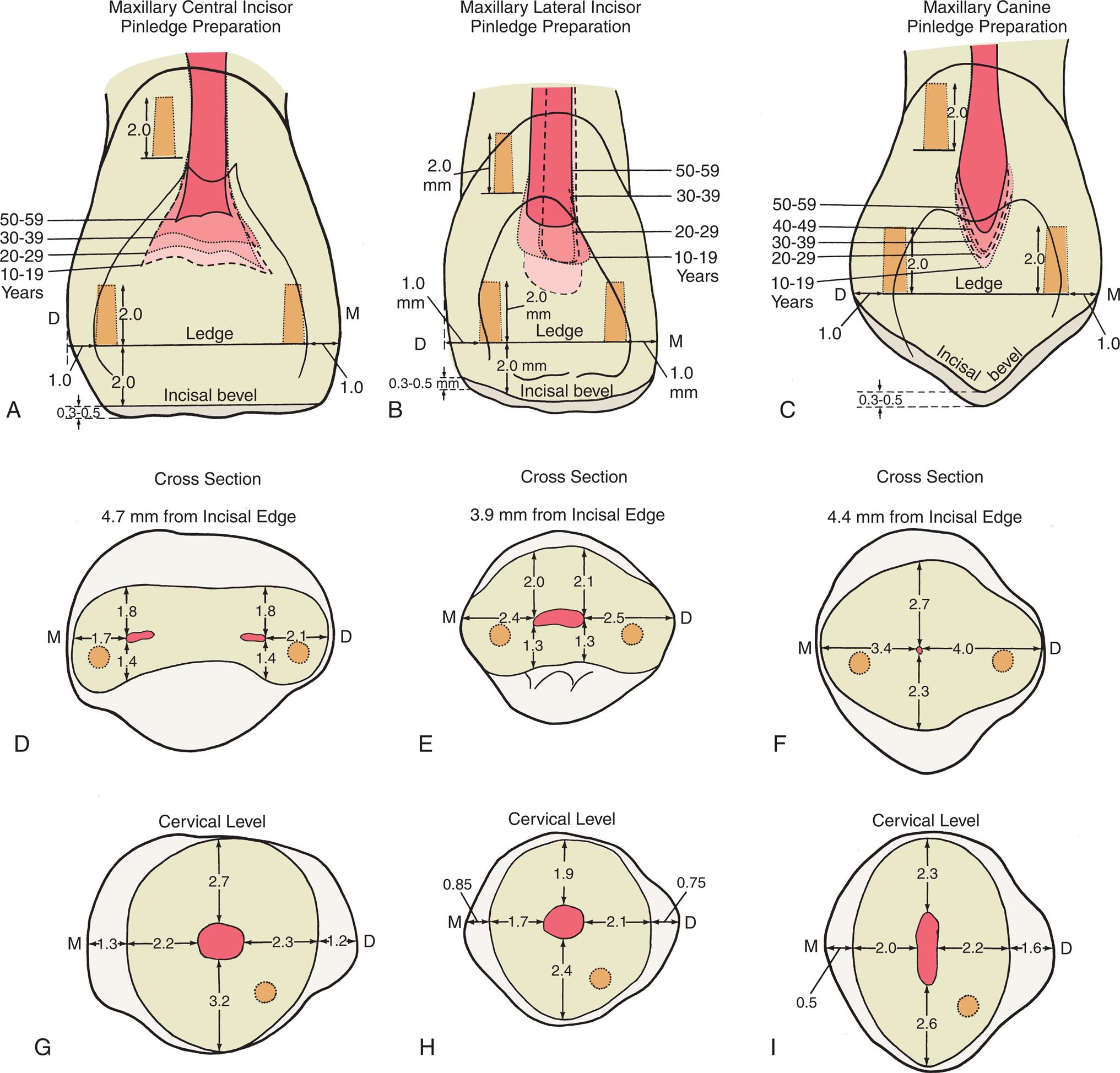 11: The Cast Partial Veneer Crown, Inlay, and Onlay Preparations