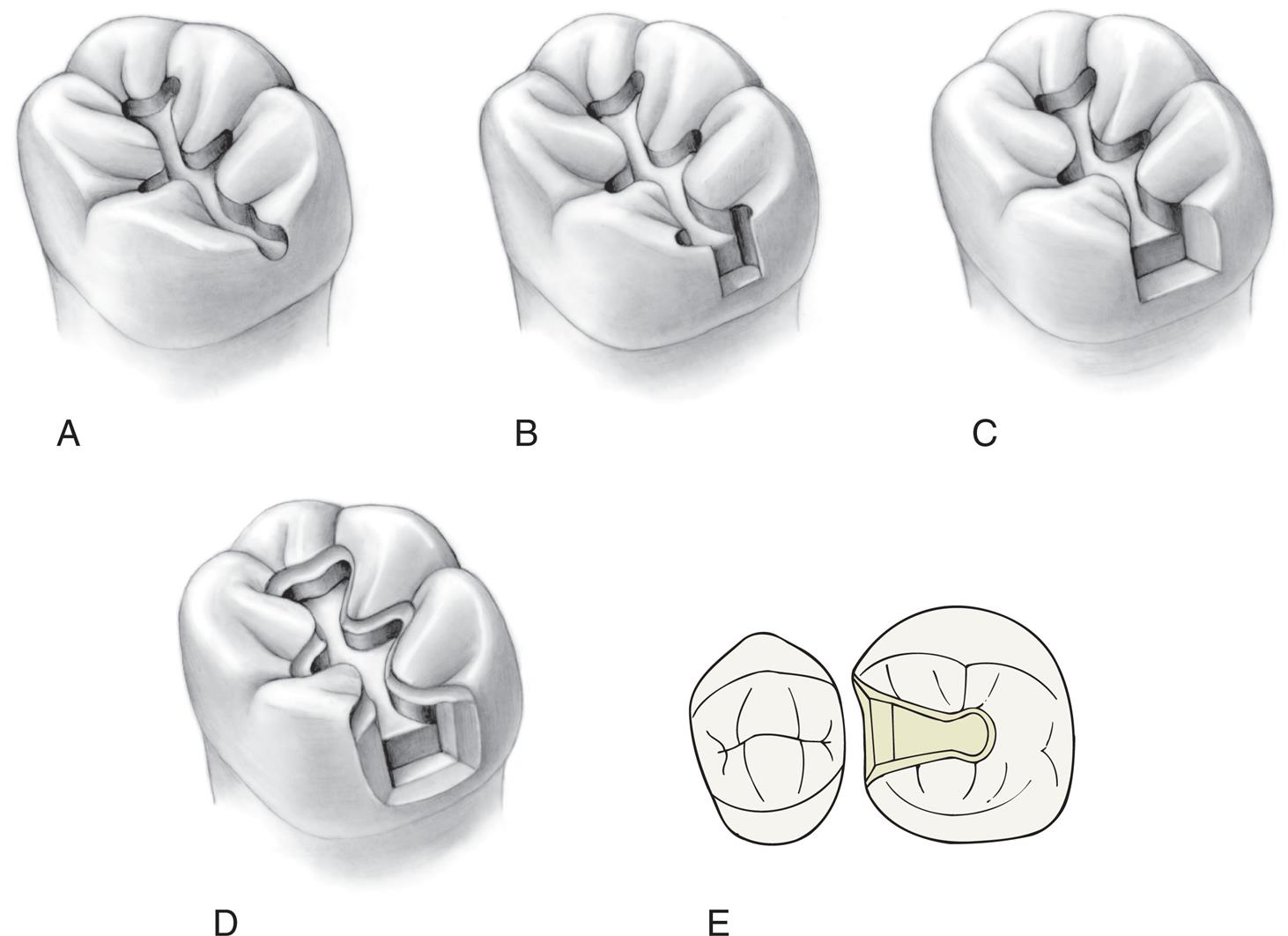 11: The Cast Partial Veneer Crown, Inlay, and Onlay Preparations