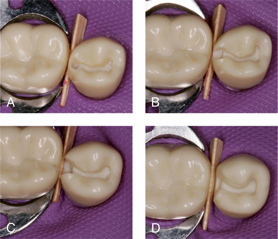 11: The Cast Partial Veneer Crown, Inlay, and Onlay Preparations