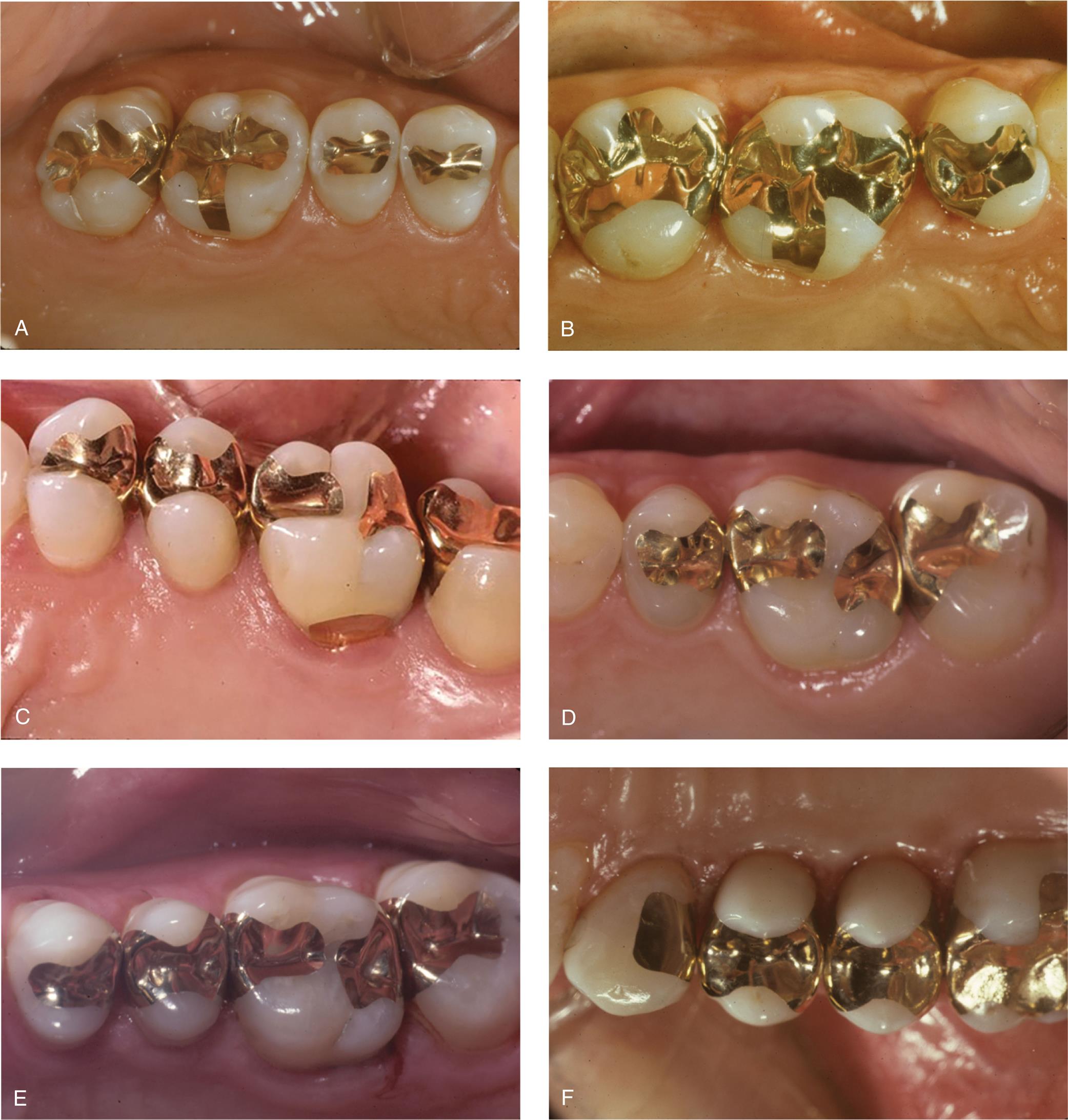 11: The Cast Partial Veneer Crown, Inlay, and Onlay Preparations