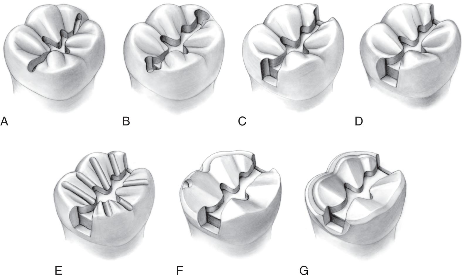 11: The Cast Partial Veneer Crown, Inlay, and Onlay Preparations
