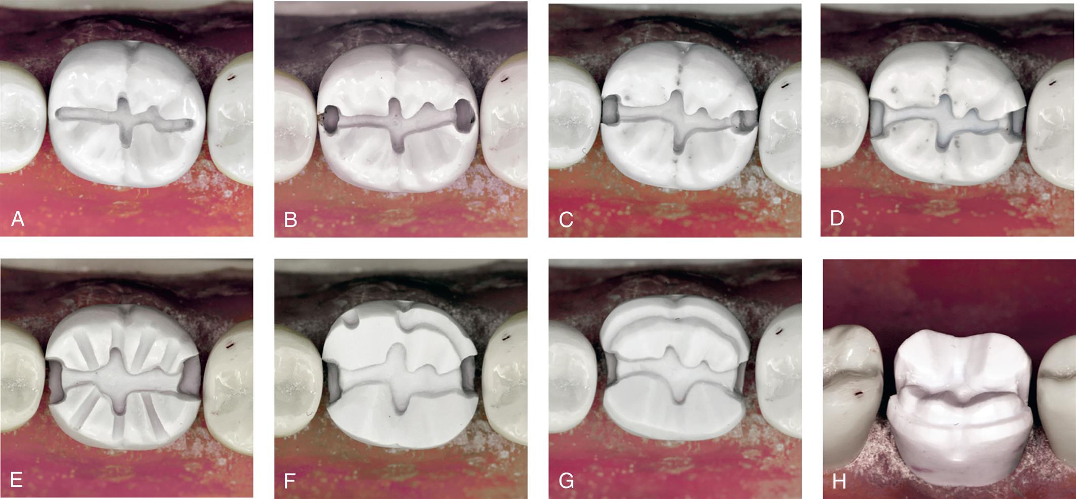 11: The Cast Partial Veneer Crown, Inlay, and Onlay Preparations