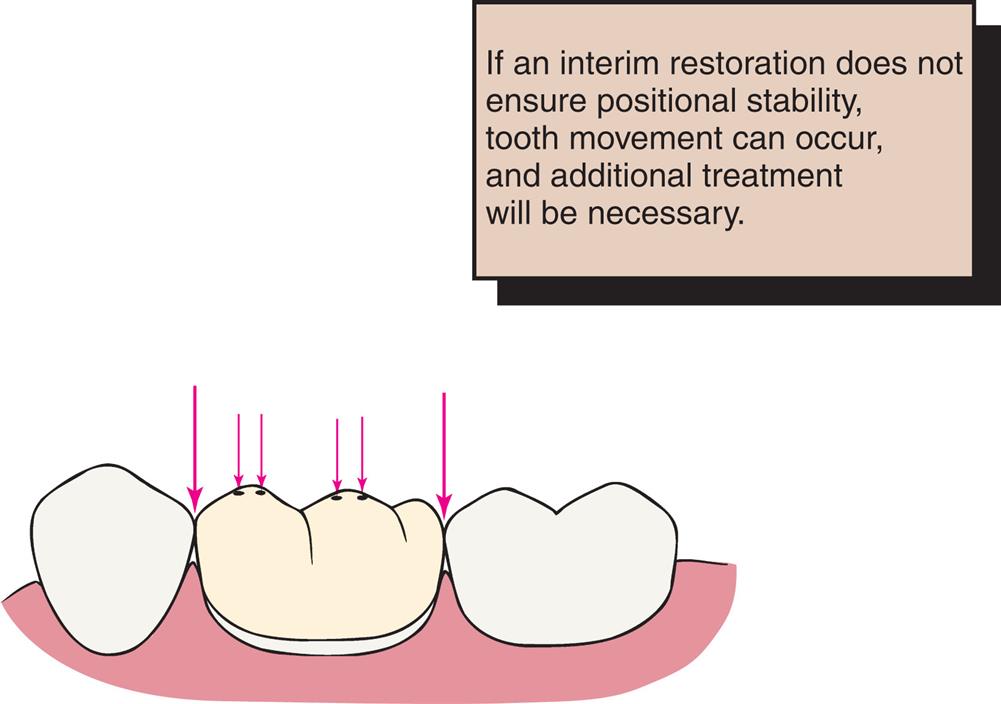15: Interim Fixed Restorations
