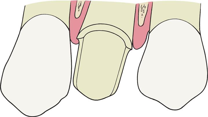 15: Interim Fixed Restorations