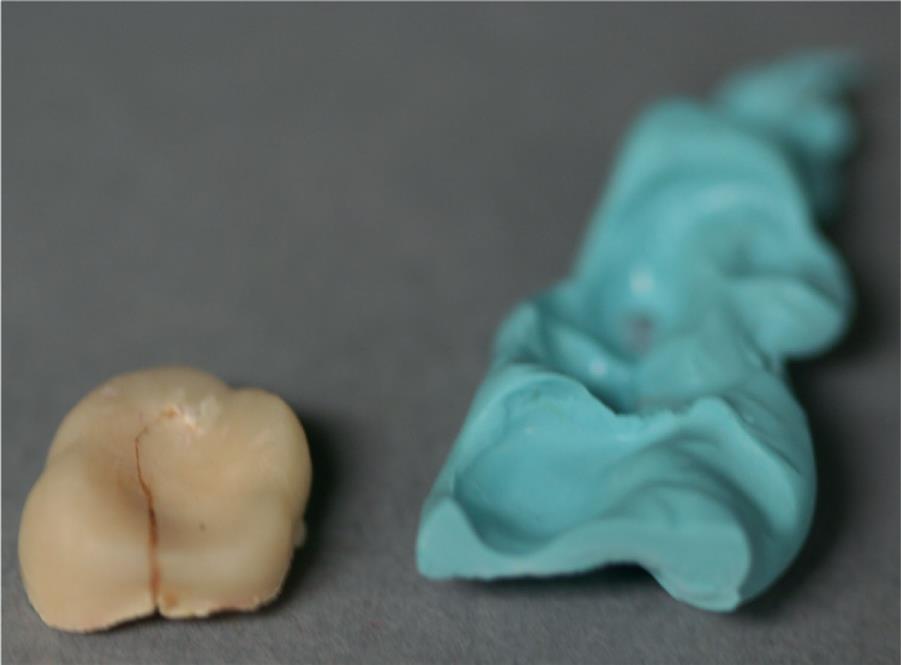 15: Interim Fixed Restorations
