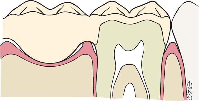 15: Interim Fixed Restorations