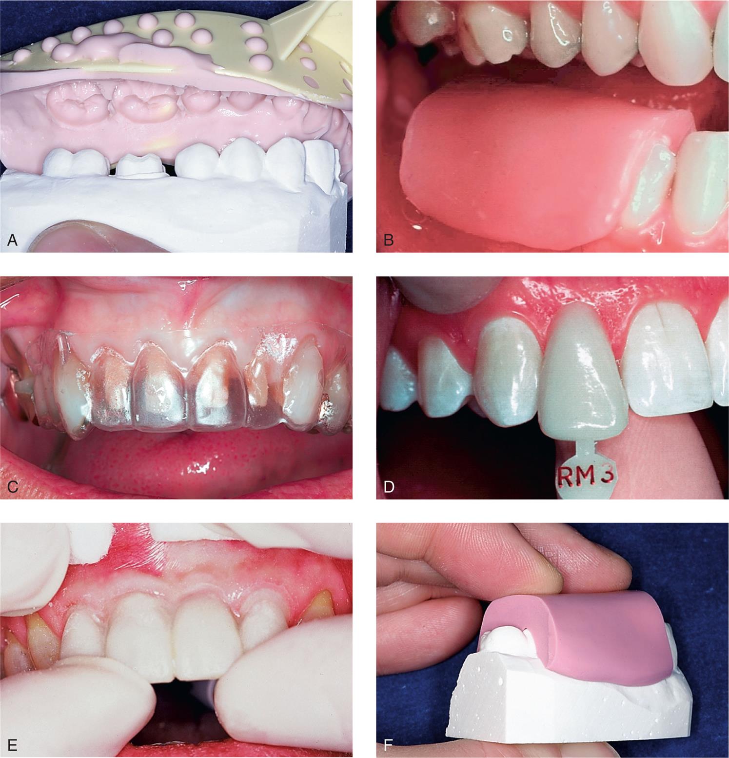 15: Interim Fixed Restorations