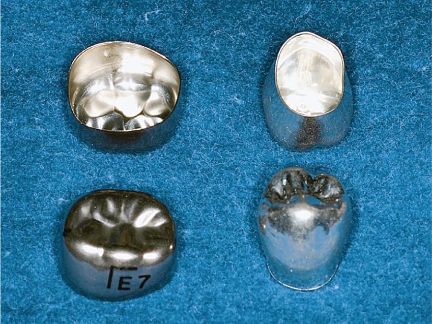 15: Interim Fixed Restorations