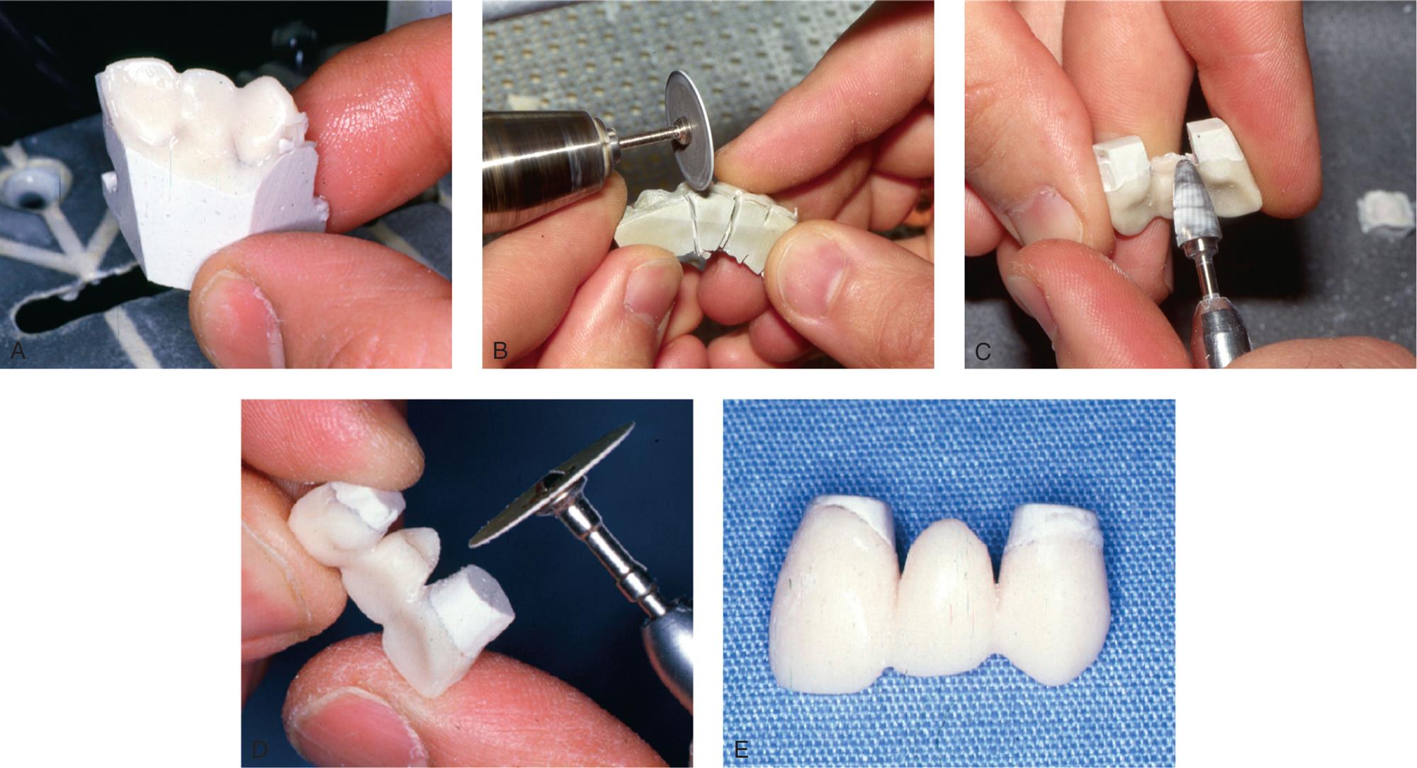 15: Interim Fixed Restorations