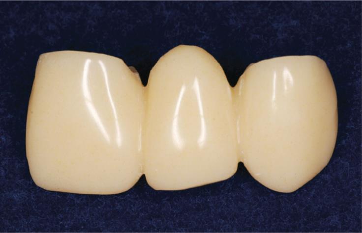 15: Interim Fixed Restorations