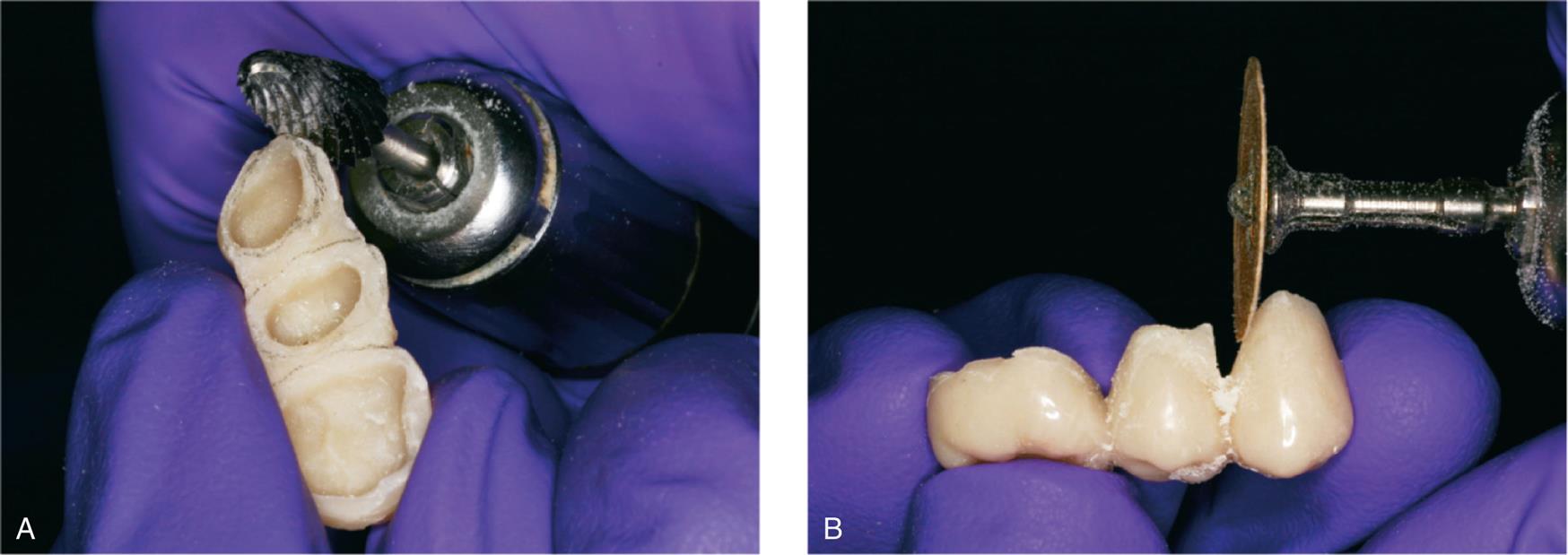 15: Interim Fixed Restorations
