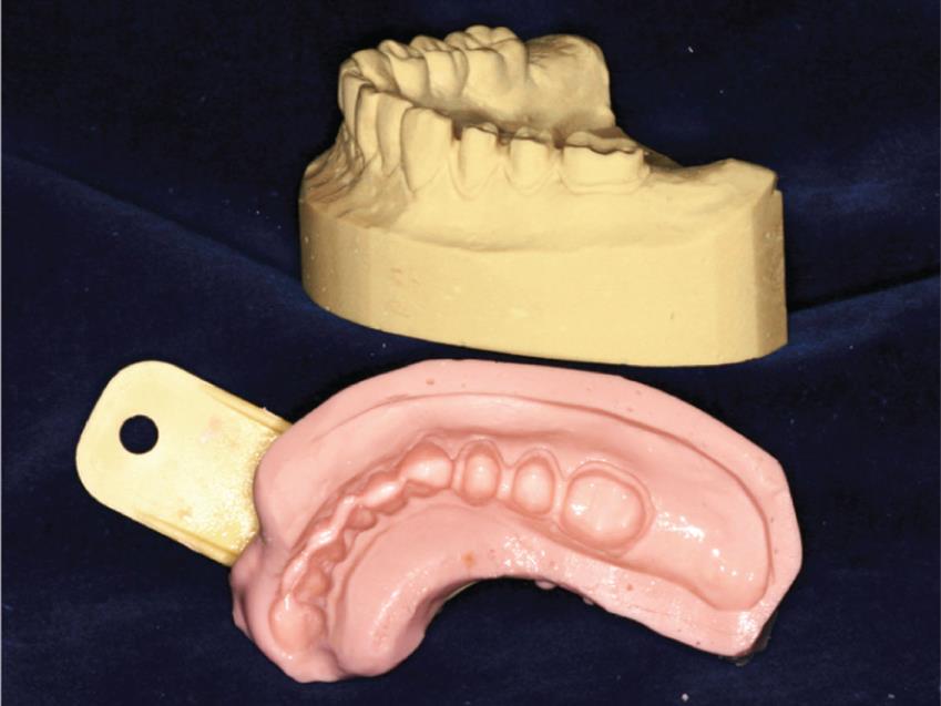 15: Interim Fixed Restorations