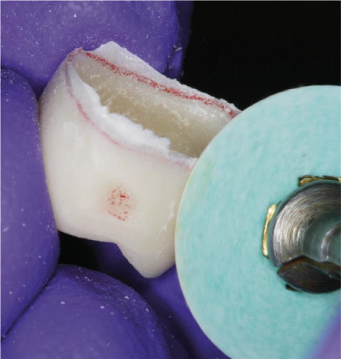 15: Interim Fixed Restorations