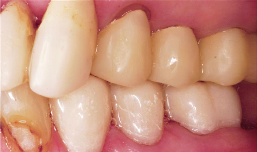 15: Interim Fixed Restorations