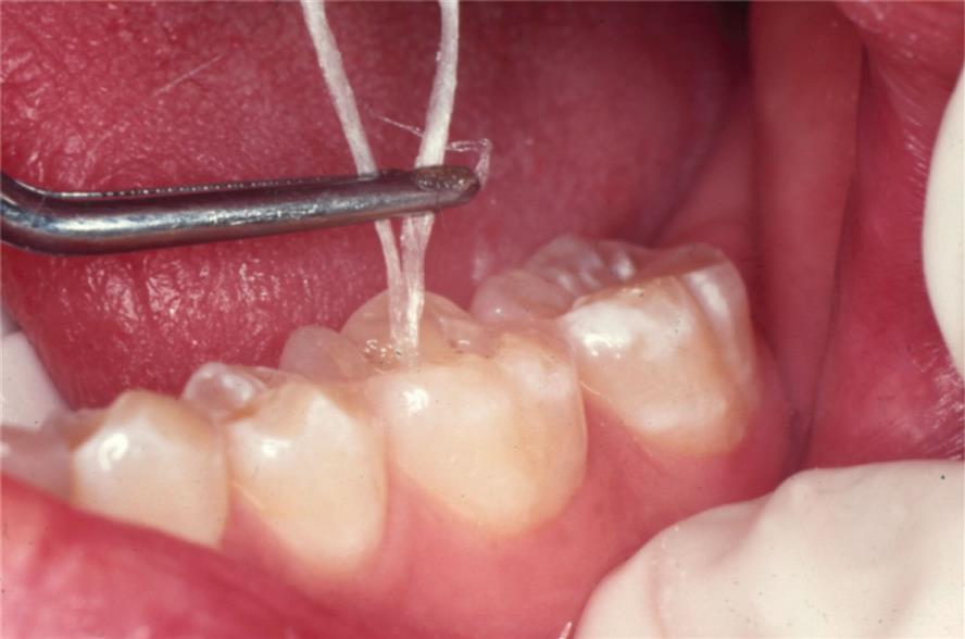 15: Interim Fixed Restorations
