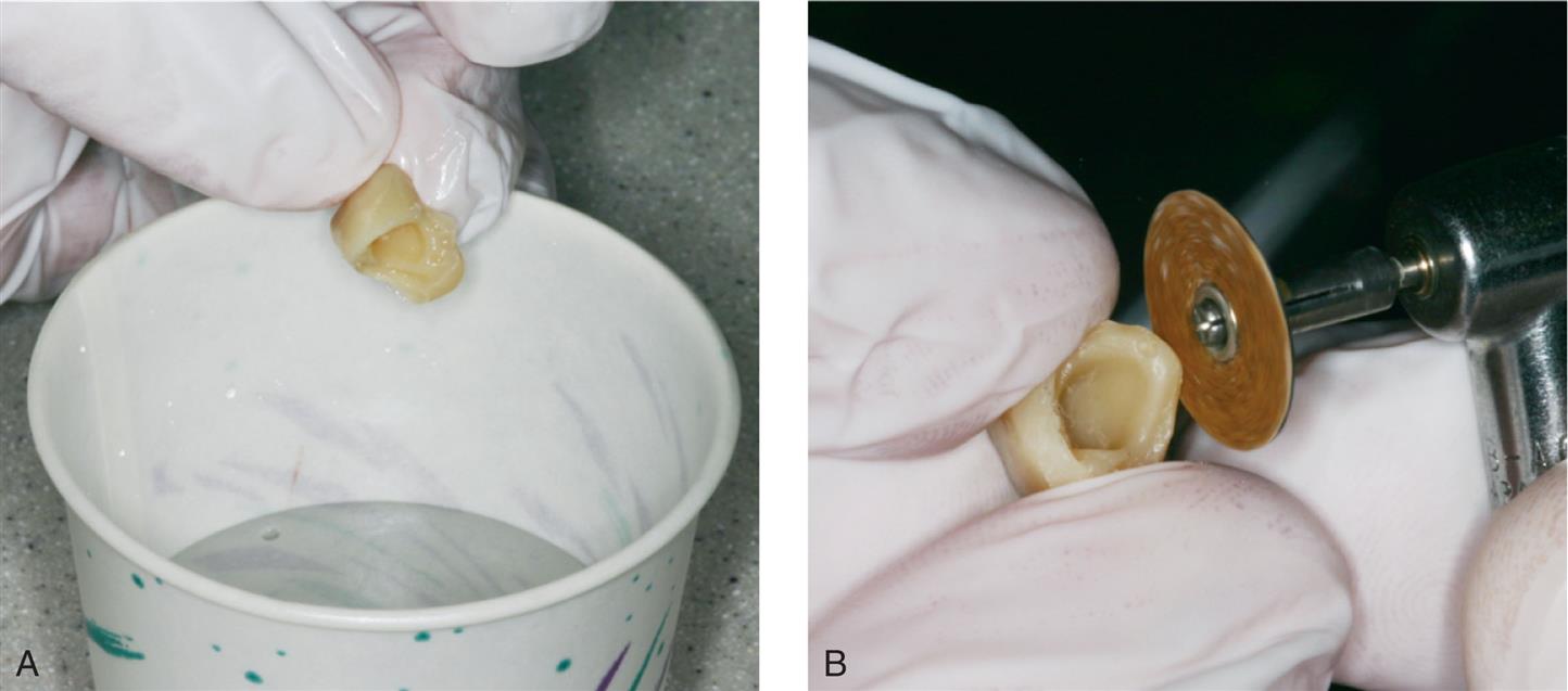 15: Interim Fixed Restorations