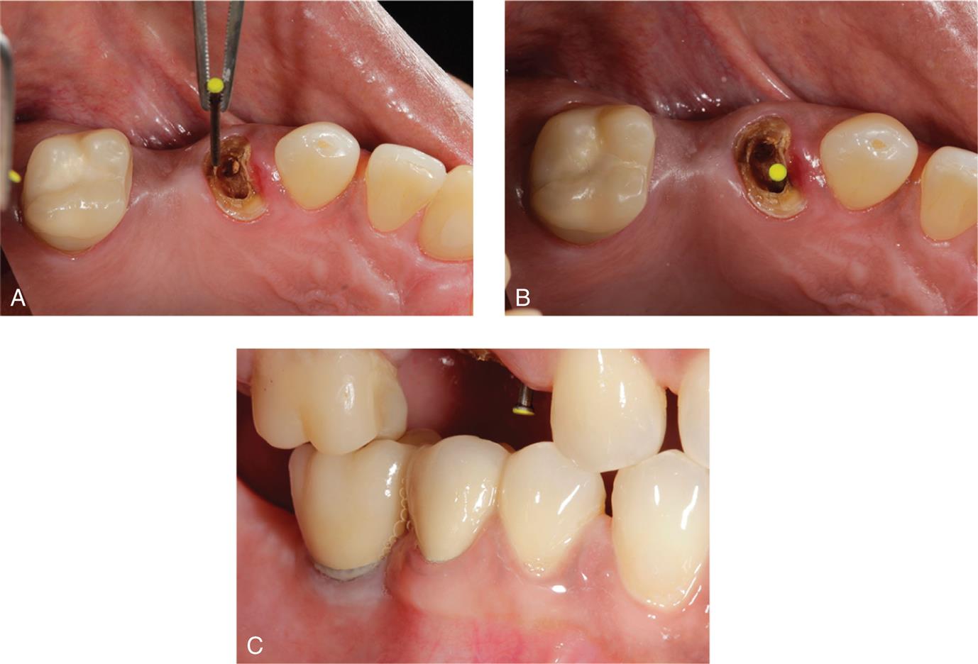 15: Interim Fixed Restorations