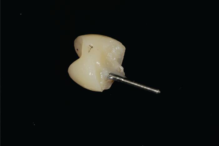 15: Interim Fixed Restorations